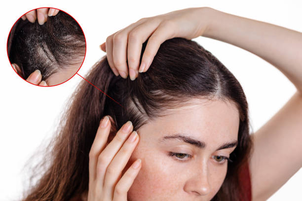 Hyperandrogenism and Seborrhea: A Closer Look at Scalp Disorders in Wo ...